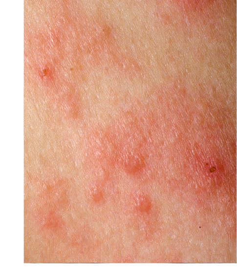 Guides | Dermatitis Diet
